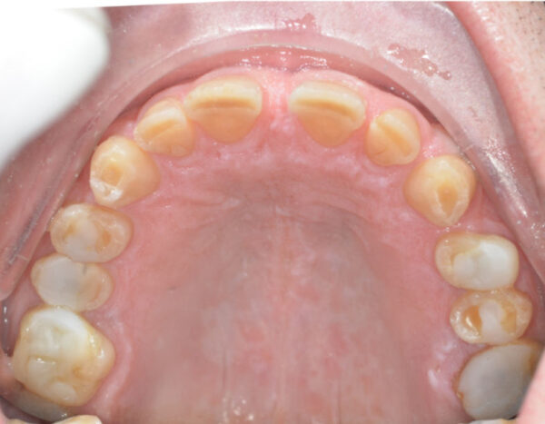 Dents usées, fêlures aux dents, fracture de dent- Clinique ICO
